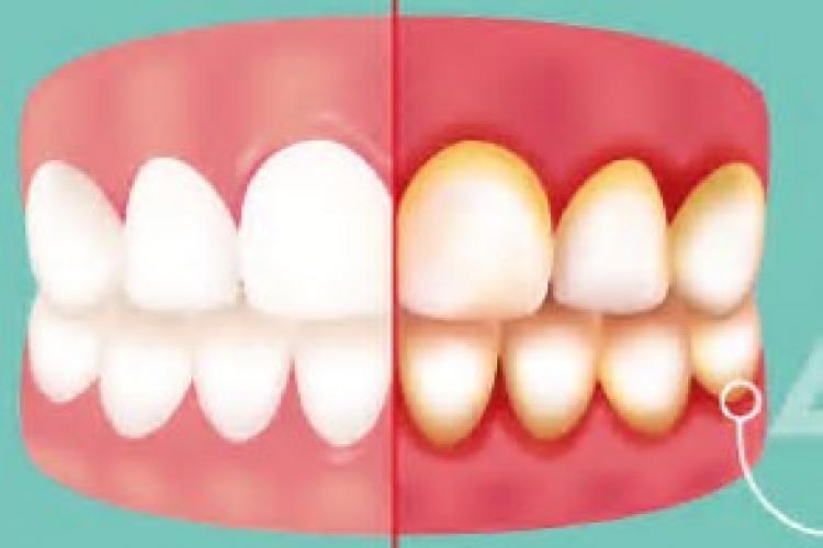 Healthy Gums Vs Gingivitis
